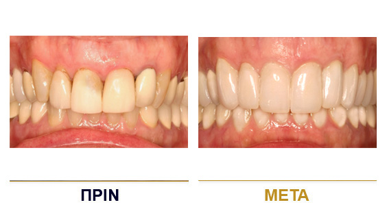 ΛΕΥΚΑΝΣΗ ΔΟΝΤΙΩΝ – VF DENTAL CLINIC