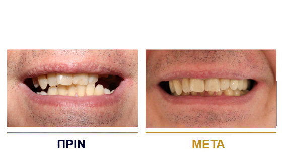 ΟΔΟΝΤΙΚΑ ΕΜΦΥΤΕΥΜΑΤΑ – VF DENTAL CLINIC