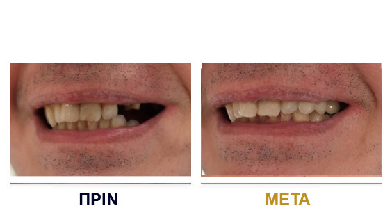 ΟΔΟΝΤΙΚΑ ΕΜΦΥΤΕΥΜΑΤΑ – VF DENTAL CLINIC